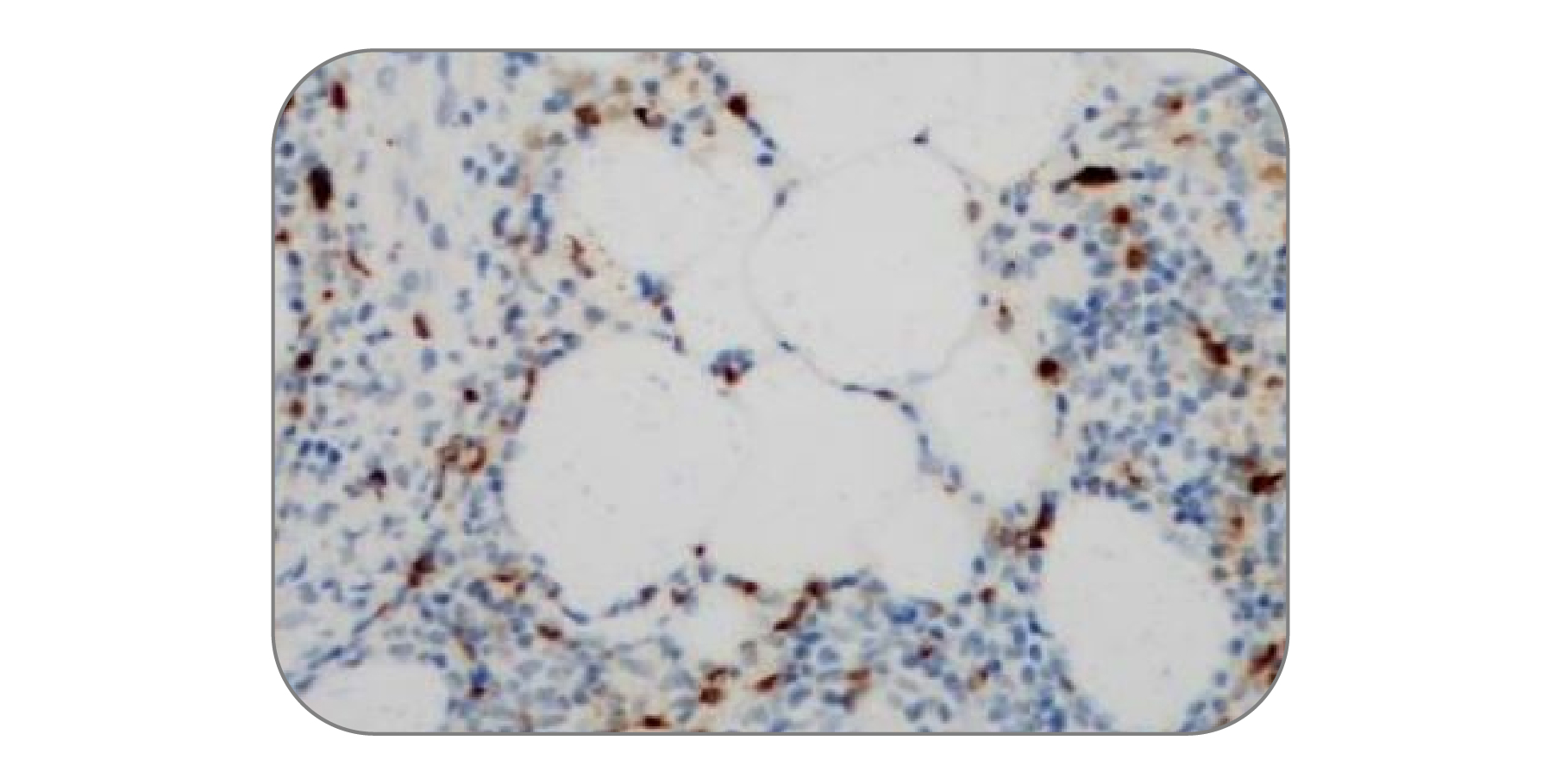 Anti-SerpinB9 therapy, a new strategy for cancer therapy - News ...